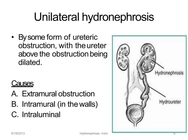 Hydronephrosis | PPTX