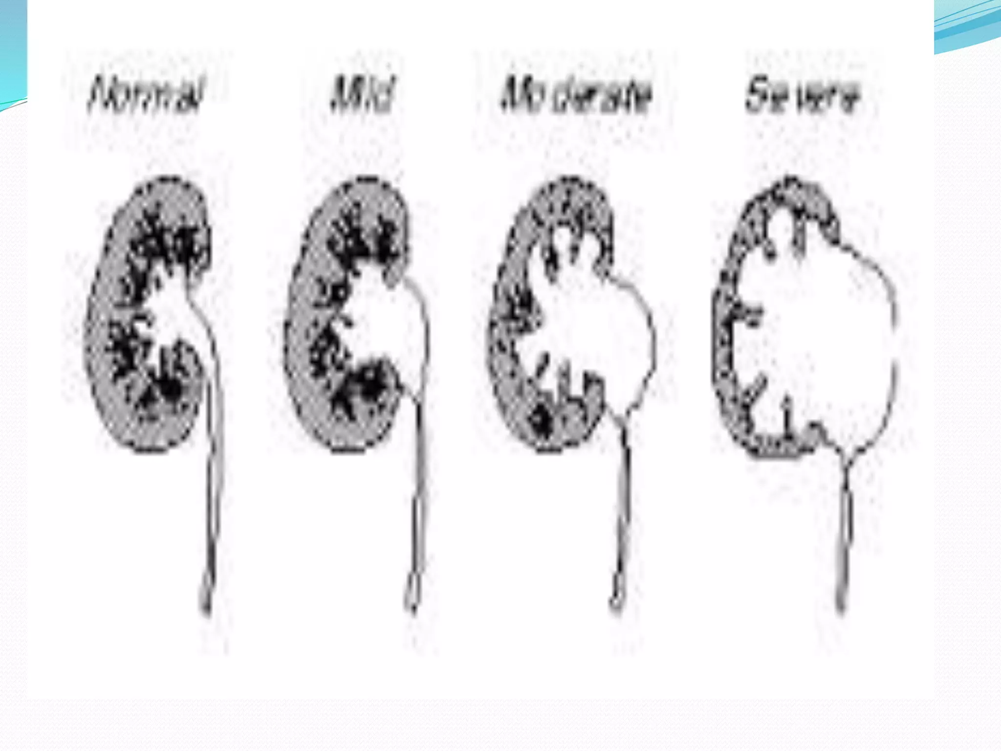 Hydronephrosis | PPTX