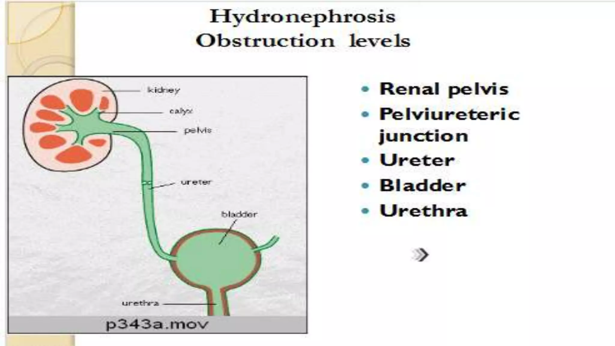 Hydronephrosis | PPTX