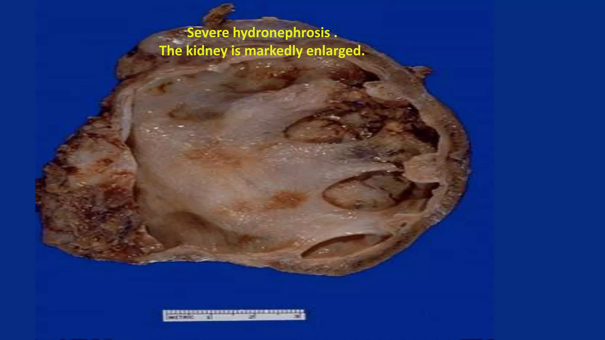 Hydronephrosis | PPTX