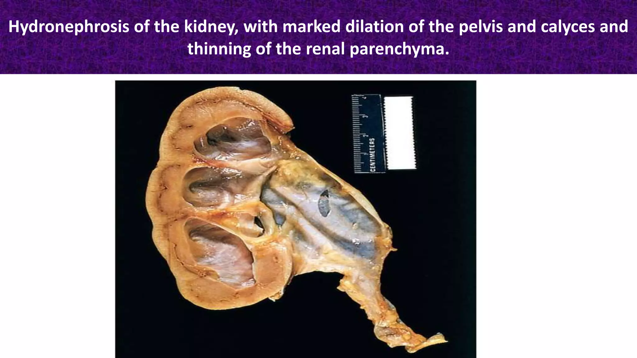 Hydronephrosis | PPTX