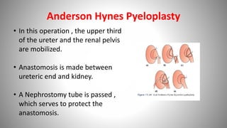 Hydronephrosis | PPTX
