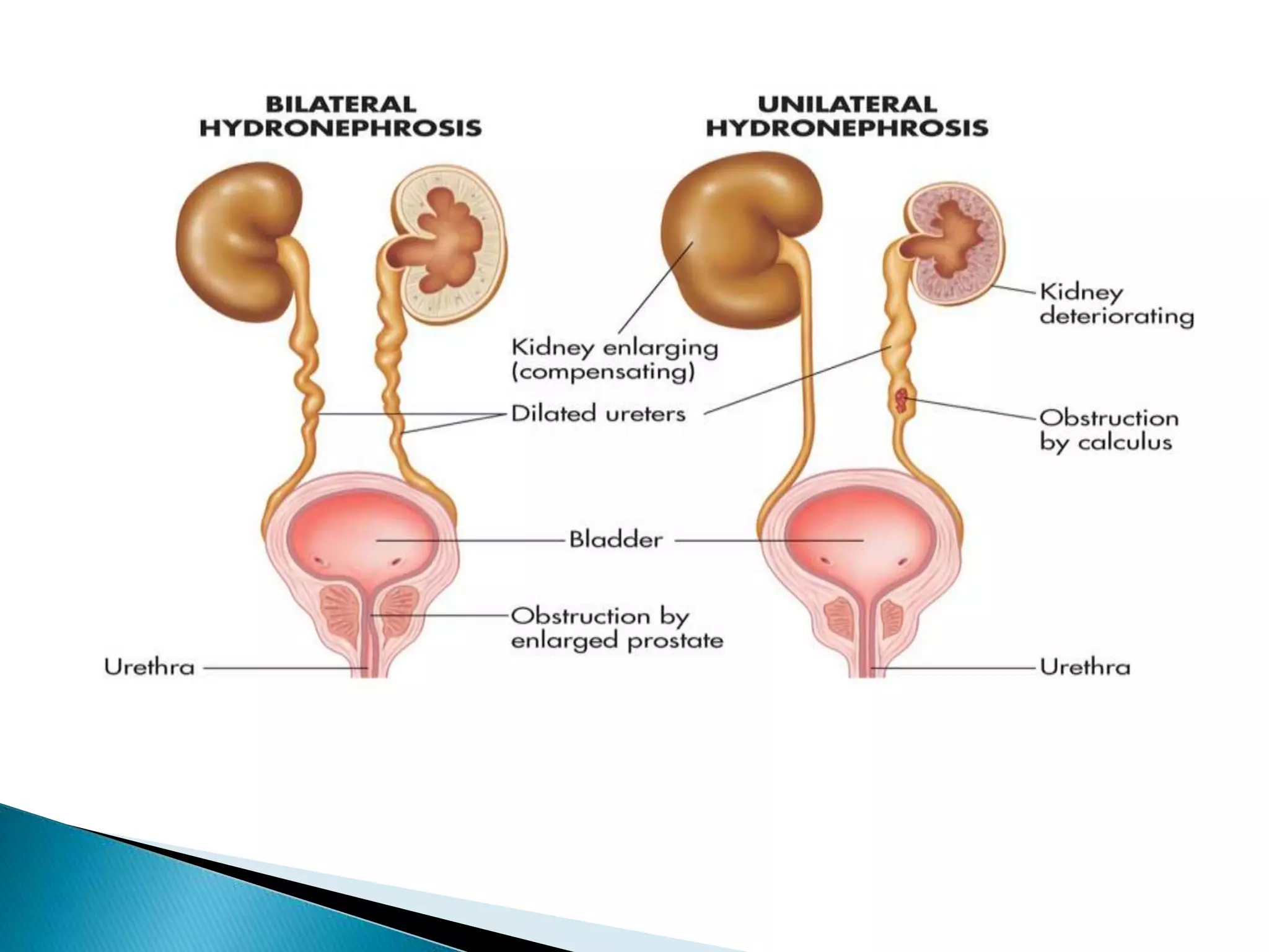 Hydronephrosis | PPTX
