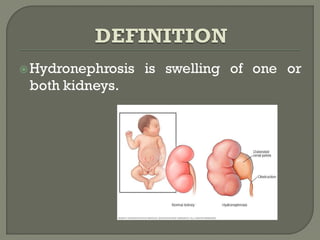 Hydronephrosis | PDF