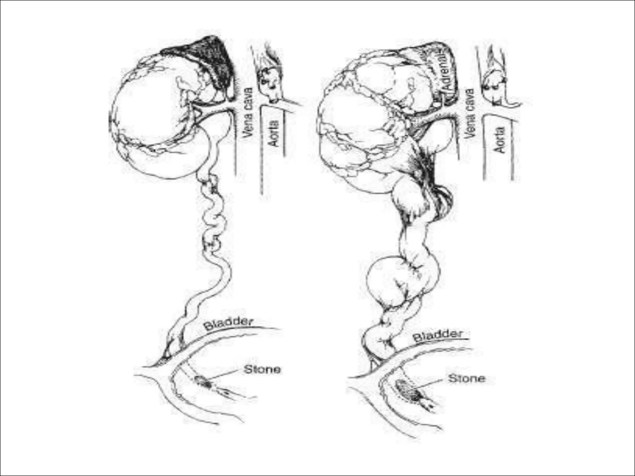 Hydronephrosis Pptx