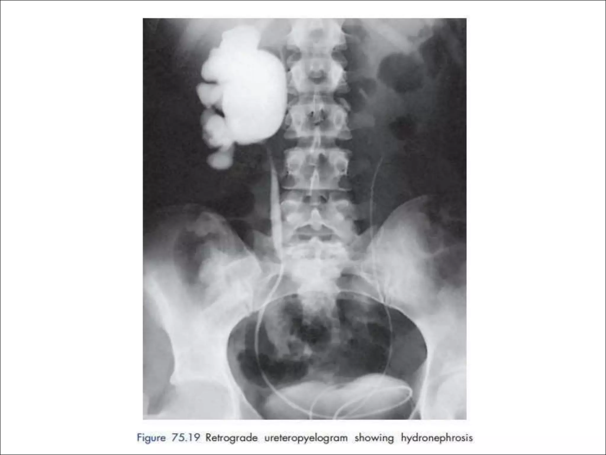 Hydronephrosis.pptx