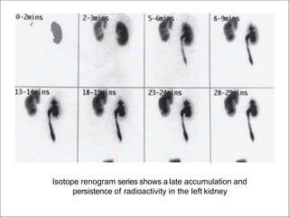 Hydronephrosis.pptx