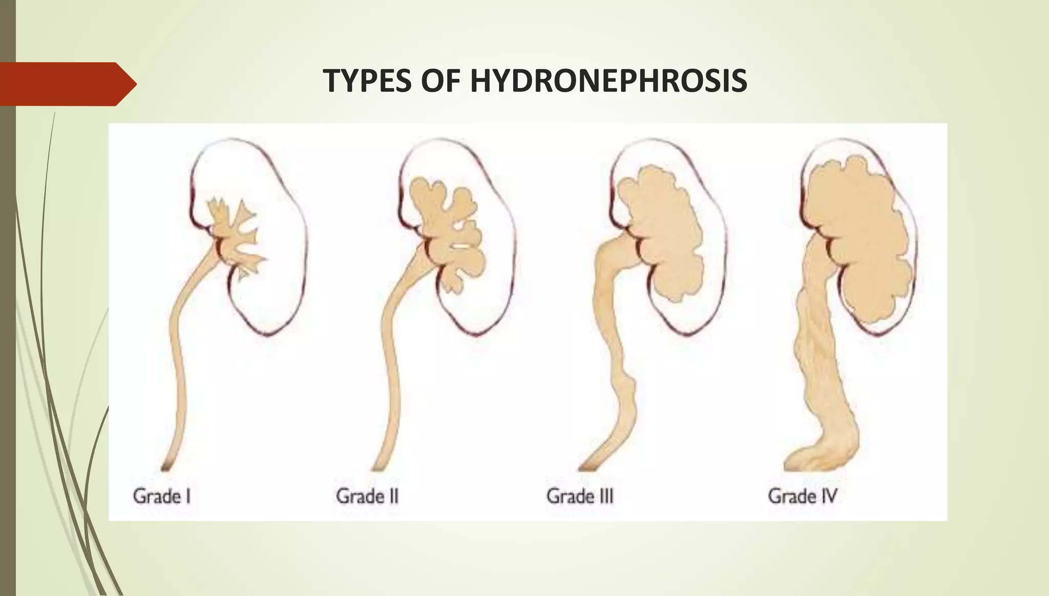 hydronephrosis.pptx