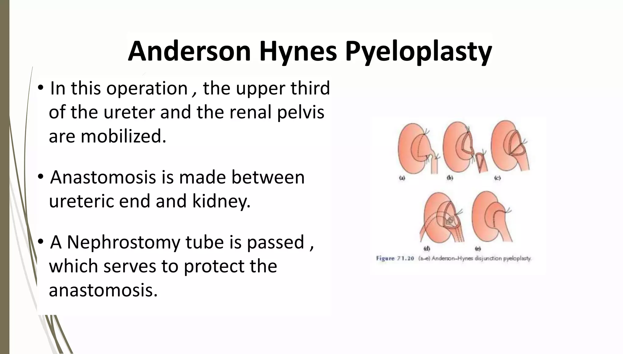 hydronephrosis.pptx