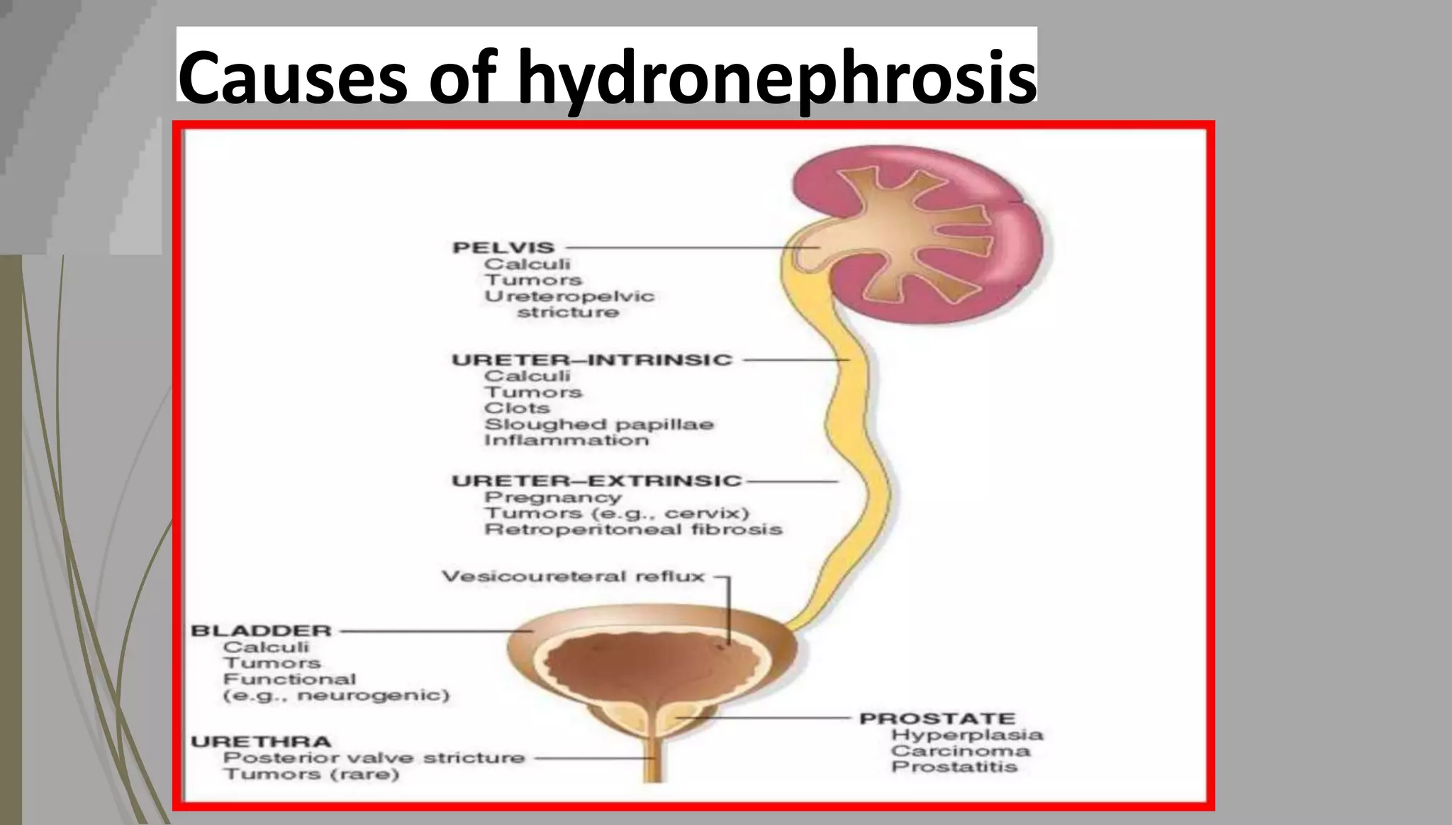 hydronephrosis.pptx
