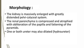hydronephrosis.pptx