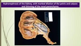 hydronephrosis.pptx