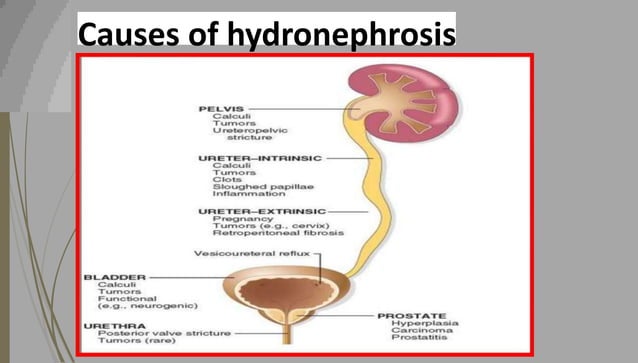 hydronephrosis.pptx | Digestive Disorders | Diseases and Conditions