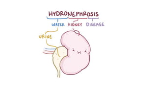 Hydronephrosis.pptx