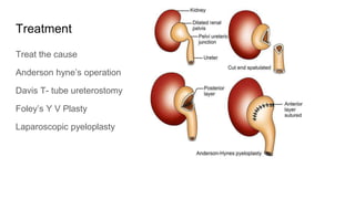 Hydronephrosis.pptx