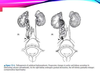 Hydronephrosis and Pyonephrosis | PPTX