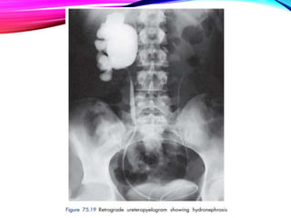 Hydronephrosis and Pyonephrosis | PPTX