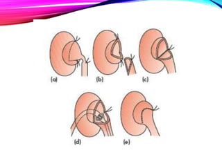 Hydronephrosis and Pyonephrosis | PPTX