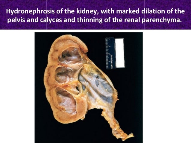 Hydronephrosis Wikidoc
