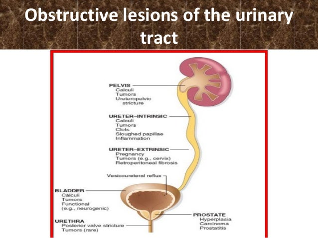 Hydronephrosis for students