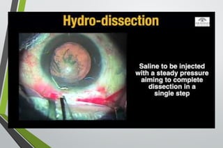 HYDROPROCEDURES include hydrodissection nad hydrodelineation | PPTX