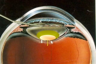 HYDROPROCEDURES include hydrodissection nad hydrodelineation | PPTX