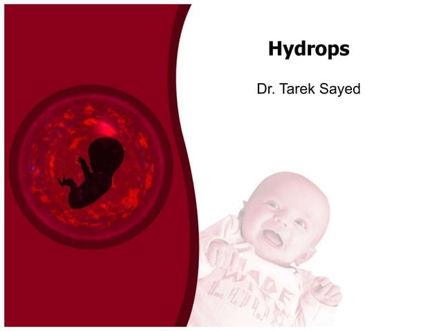 Hydrops | PPTX