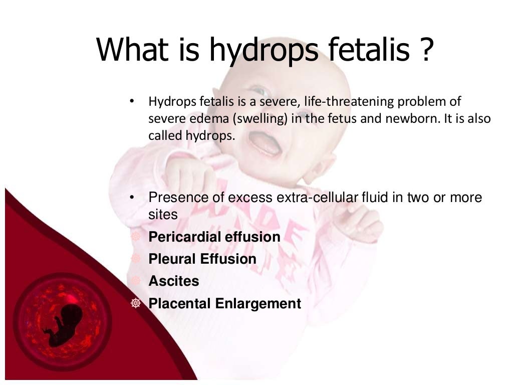 Hydrops