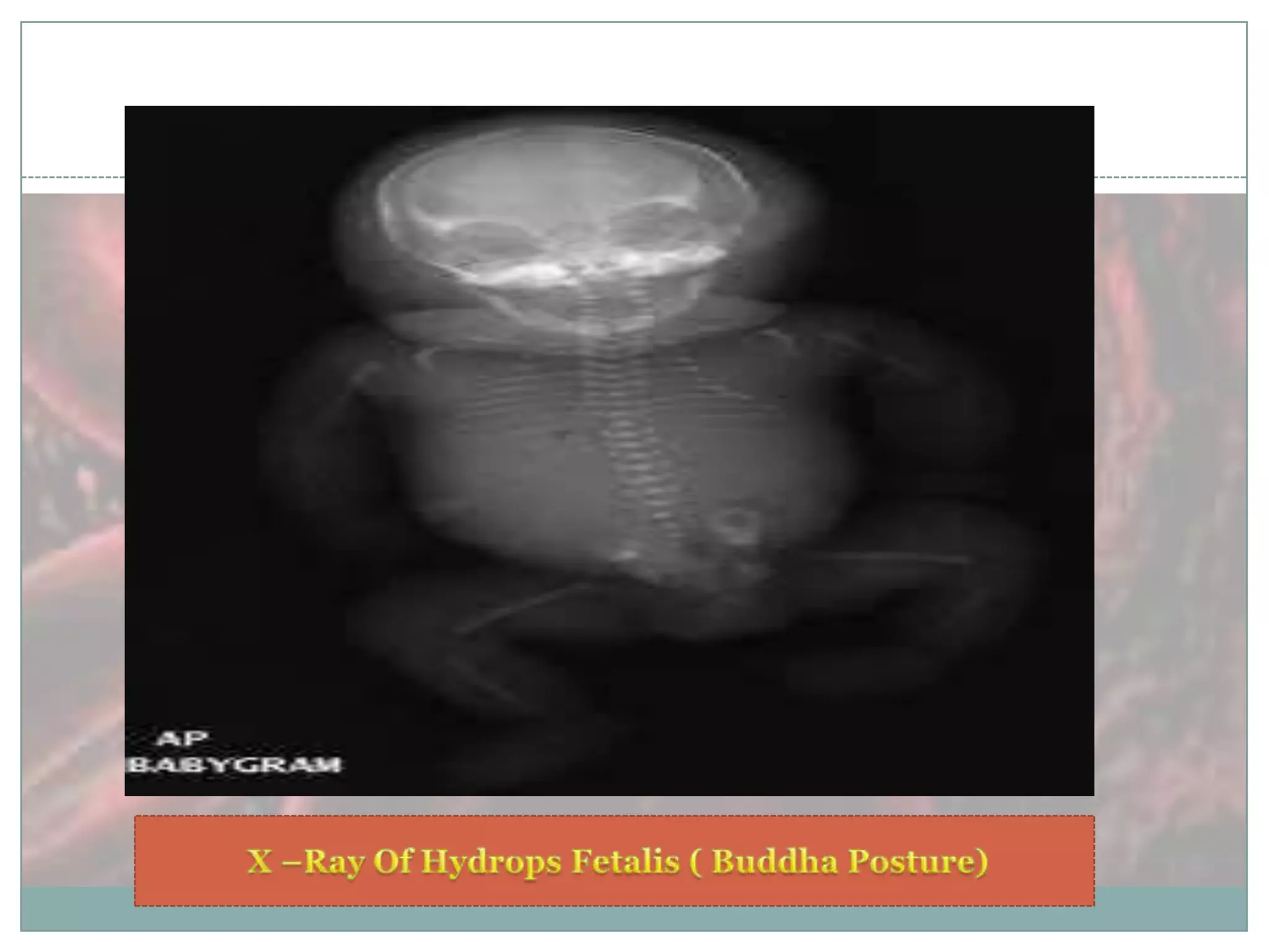 Hydrops fetalis | PPTX