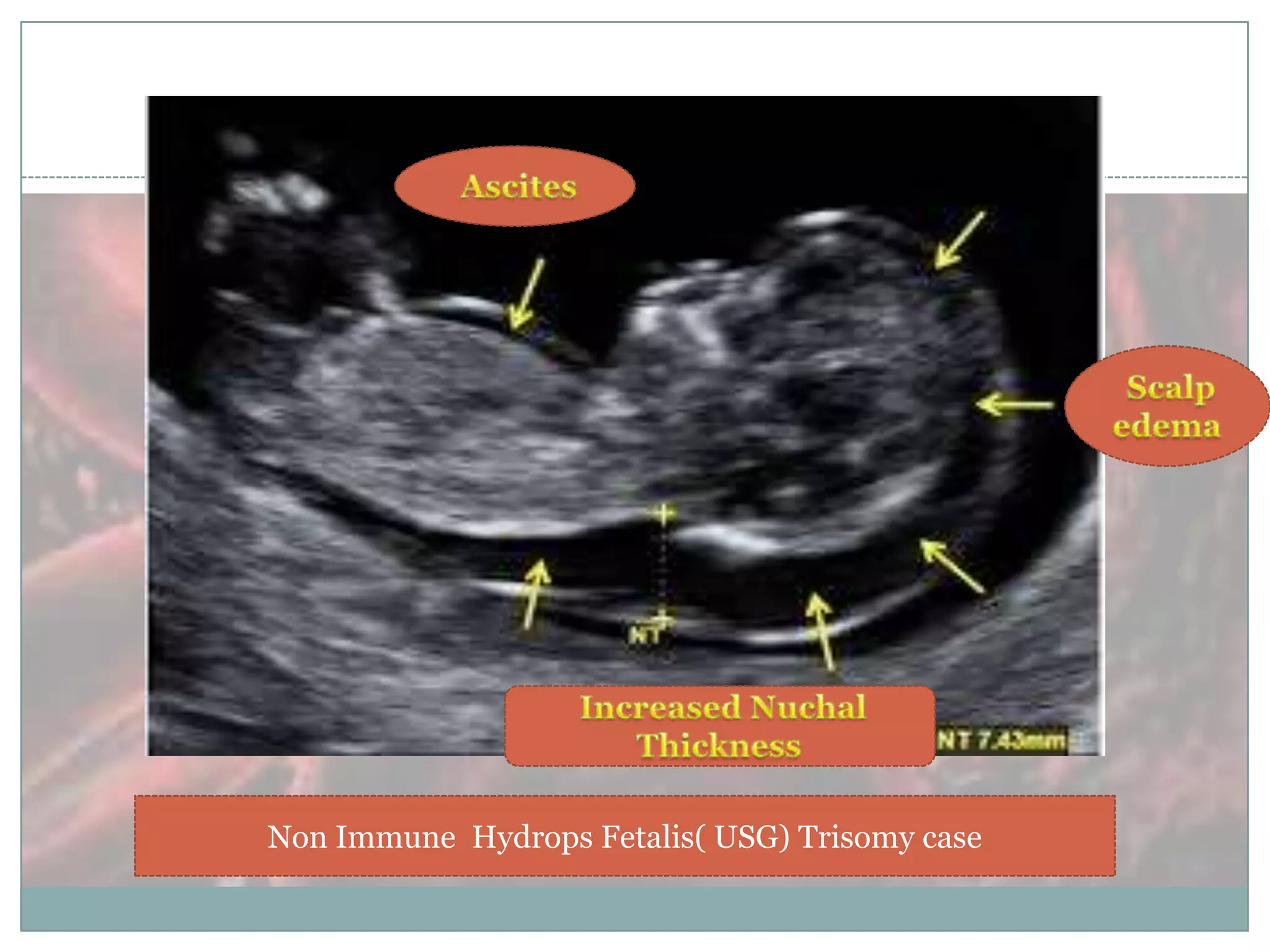 Hydrops Fetalis Gesundes Kind - Baby Schwanger