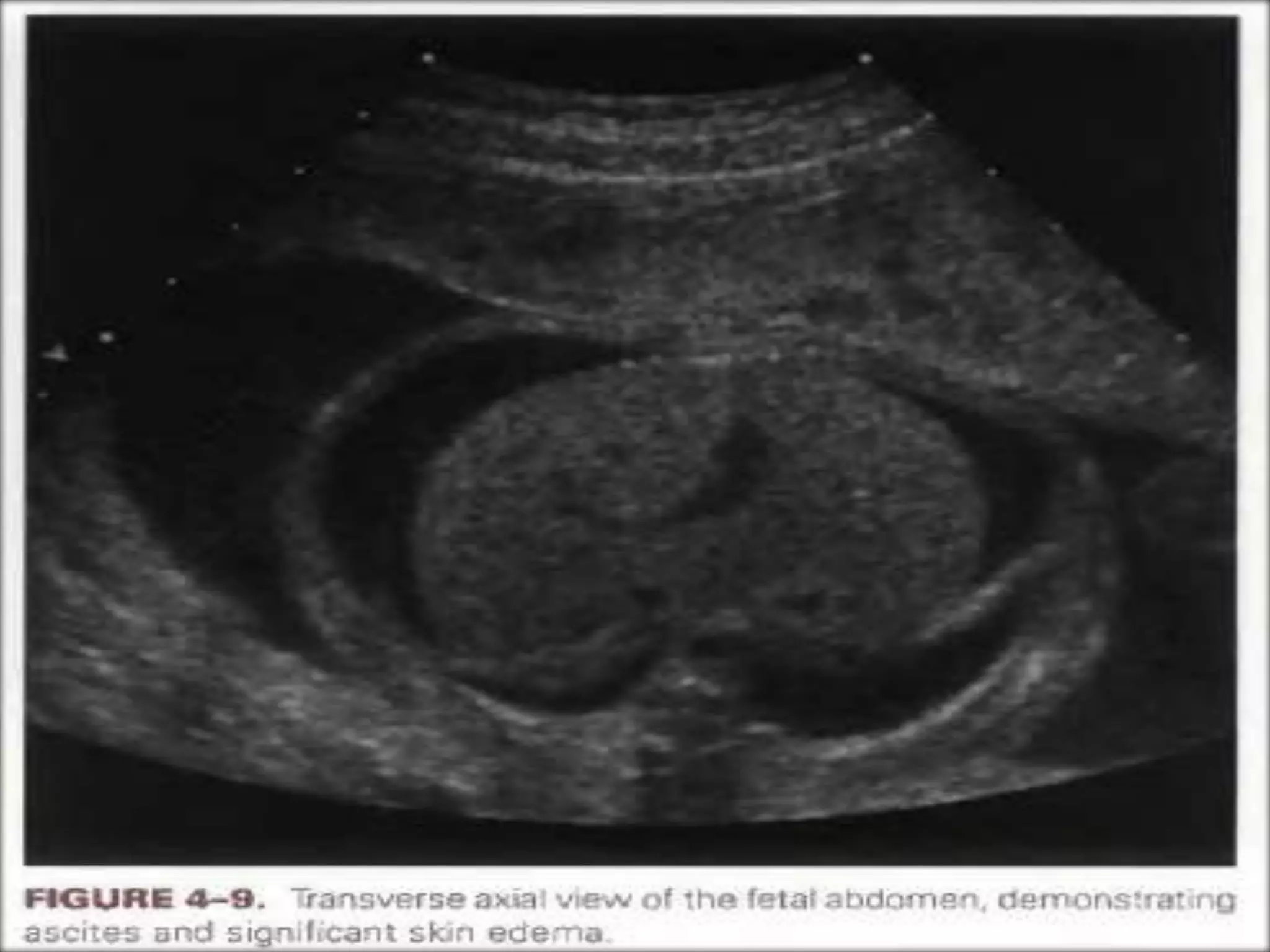 Hydrops fetalis | PPTX