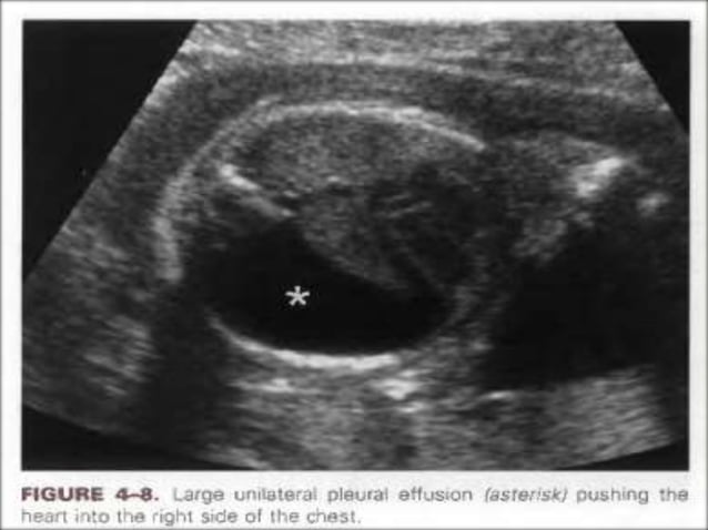 Hydrops fetalis | PPT