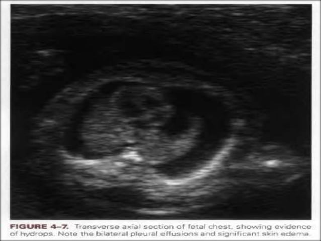 Hydrops fetalis | PPT