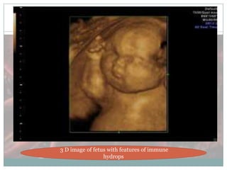 Hydrops fetalis | PPT
