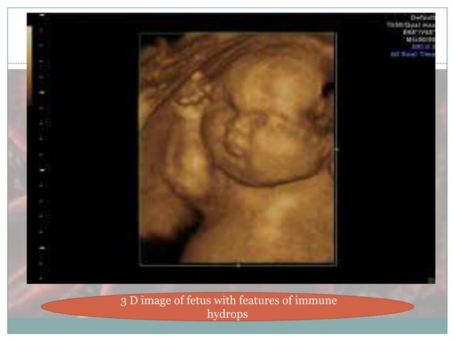 Hydrops fetalis