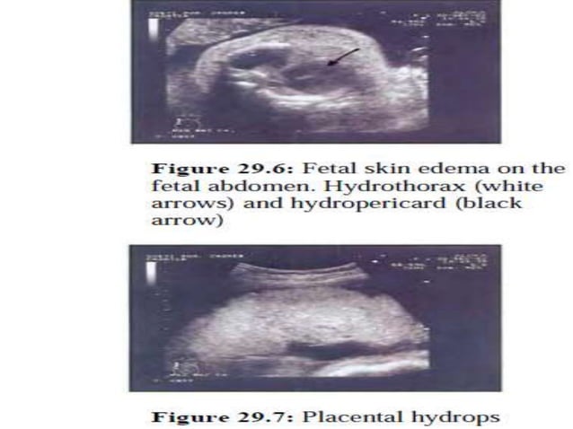 Hydrops fetalis