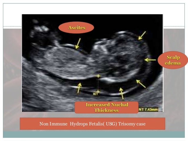 Hydrops fetalis