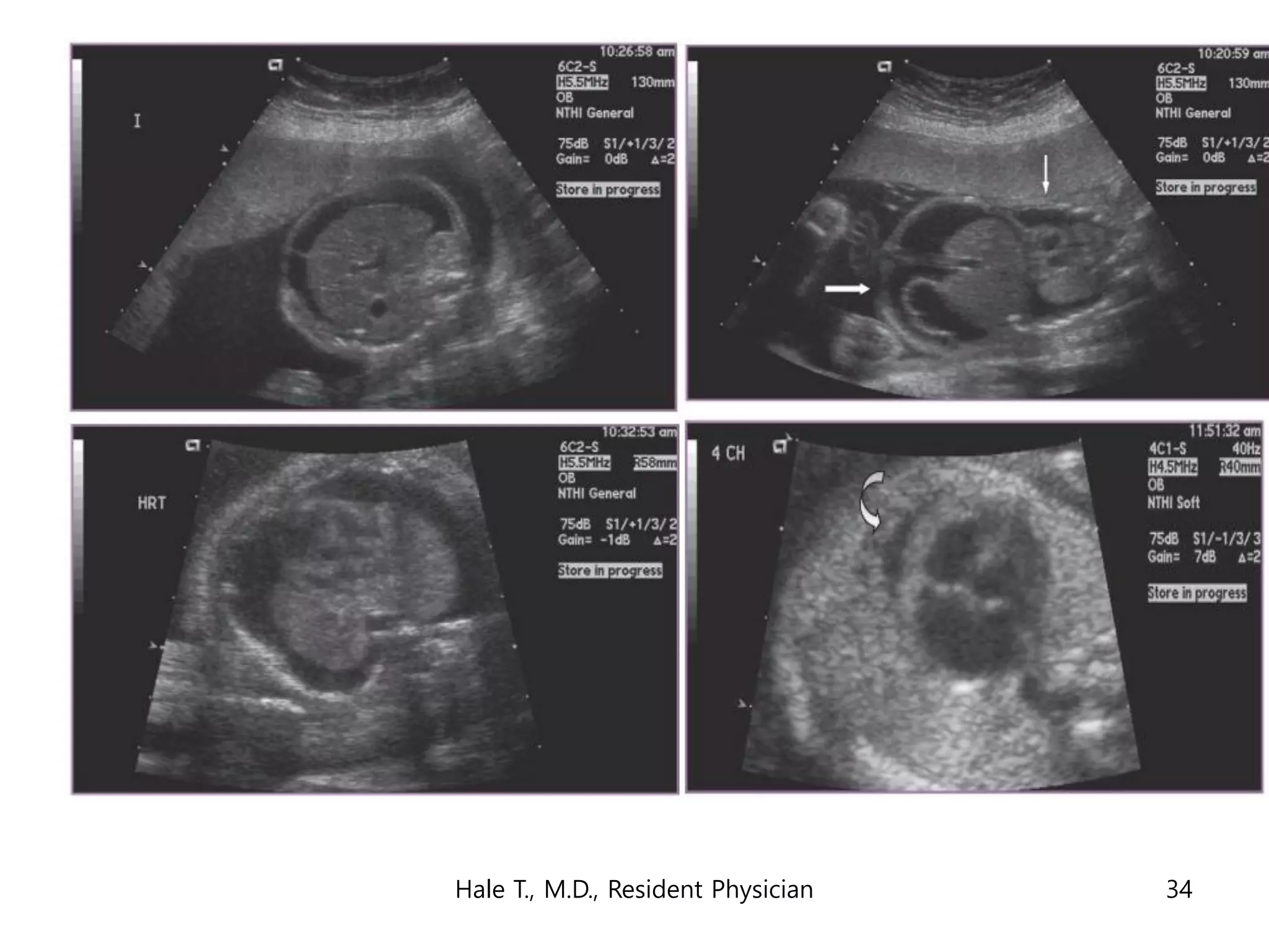 Hydrops fetalis: Immune and nonimmune fetal hydrops | PDF | Pregnancy ...