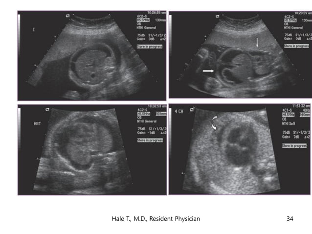 Hydrops fetalis: Immune and nonimmune fetal hydrops | PDF | Pregnancy ...