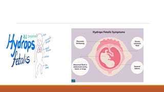 Hydrops fetalis.pptx