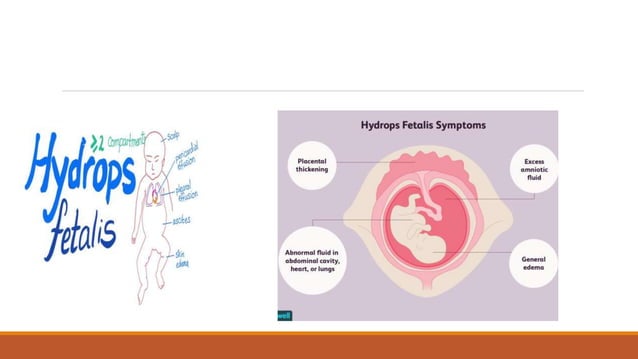 Hydrops fetalis.pptx