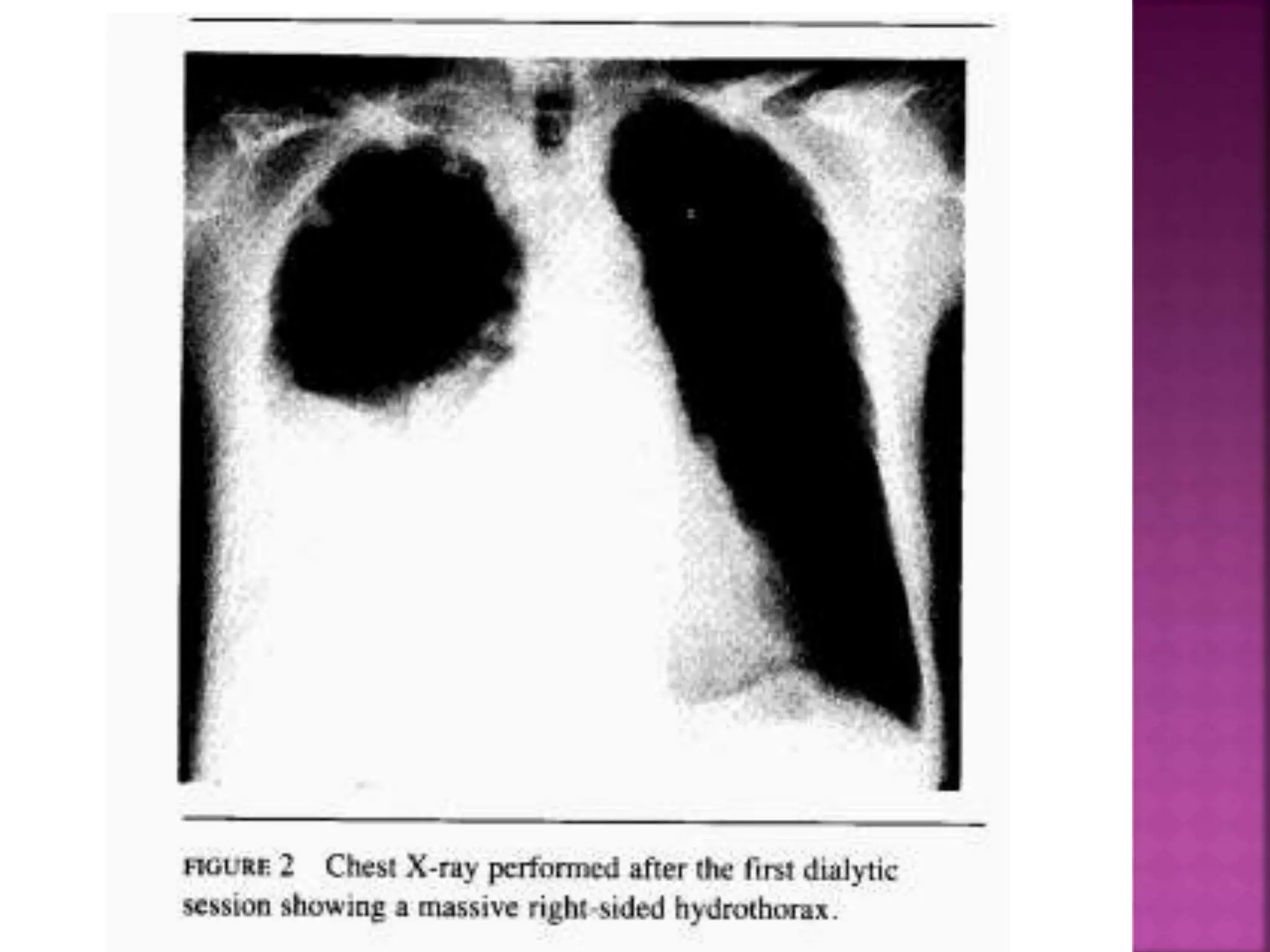 Hydrothorax fluid in cavity | PPTX