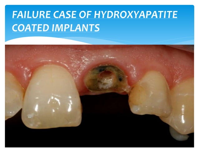 Hydroxyapatite and their use as coating material in dentistry | PPTX ...