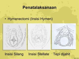 hymen imperforata.pptx presentasi hymen pada wanita | PPTX