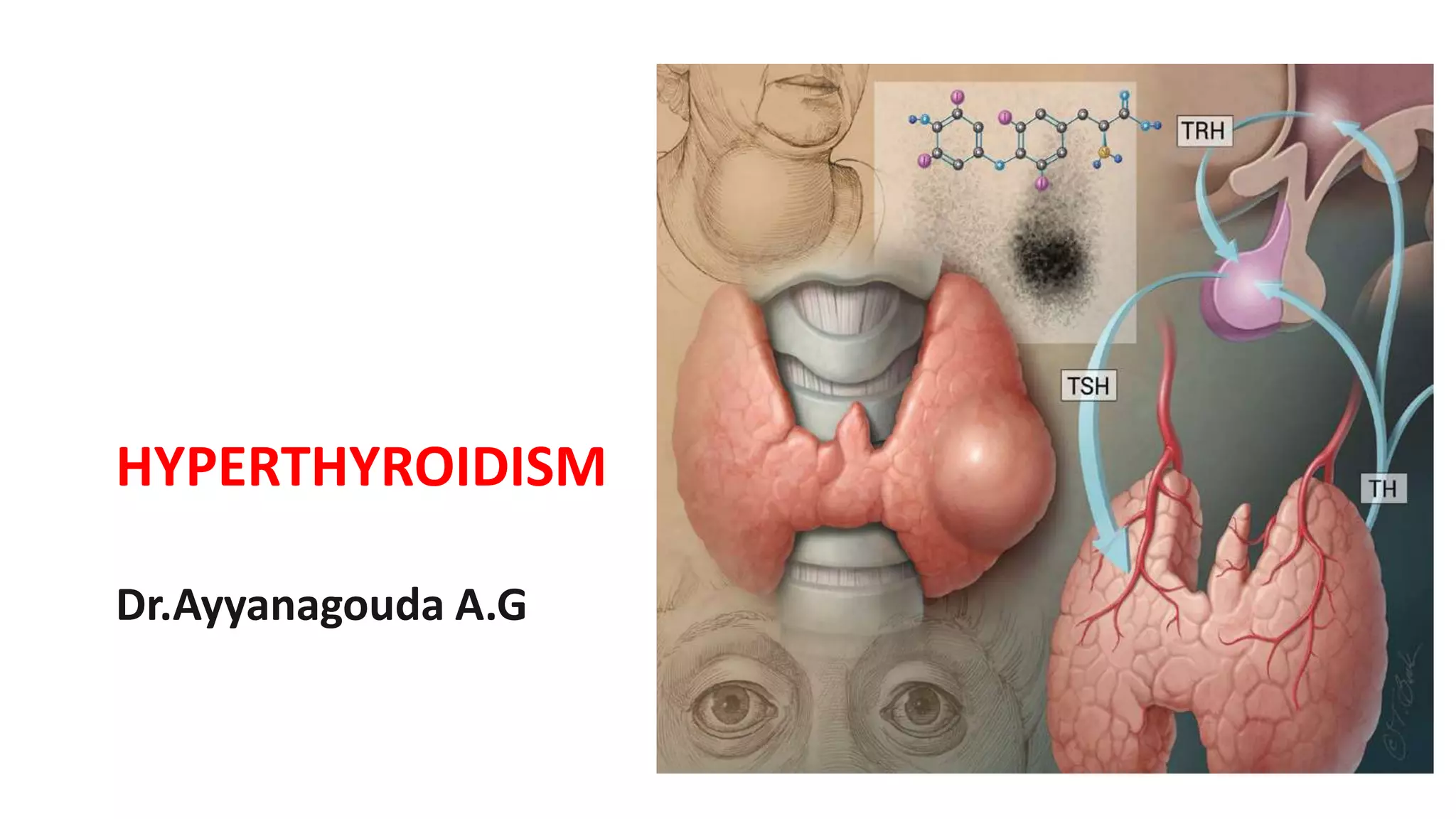 hyoerthyroidism.pptx