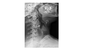 ANATOMY OF THE Hyoid bone | PDF
