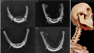 Hyoid bone journal | PPTX
