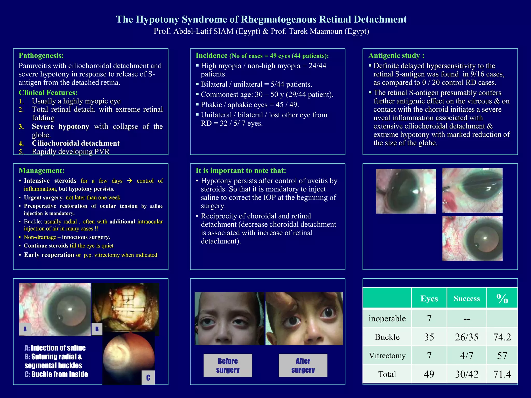 The Hypotony Syndrome of Rhegmatogenous Retinal Detachment | PPTX