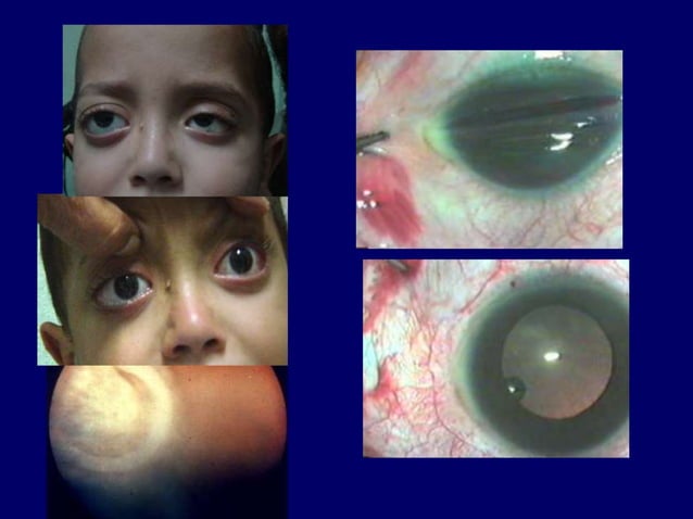 The Hypotony Syndrome of Rhegmatogenous Retinal Detachment | PPT