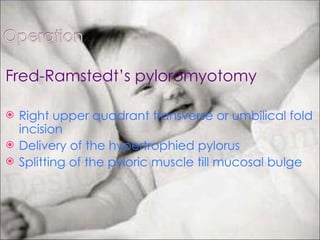 Infantile Hypertrophic Pyloric Stenosis.ppt